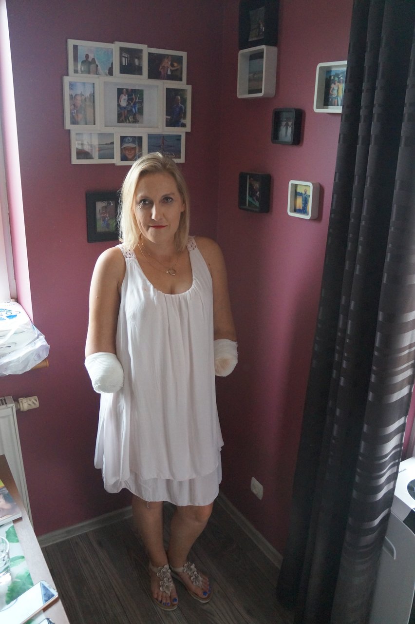 Arm amputee ladies - Дамы с ампутированной рукой