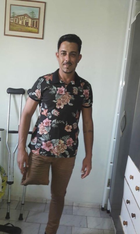 photos of male stumps - Page 2 - Amputee Devotee