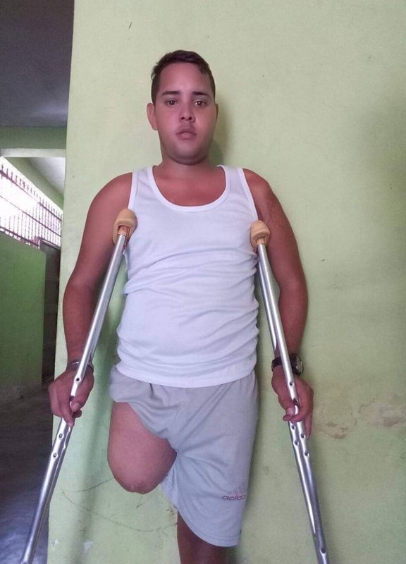 photos of male stumps - Page 2 - Amputee Devotee